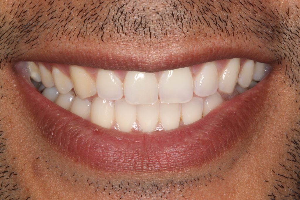 Rock'n'Roll Dental » CLOSING THE GAP- DIASTEMA SPACE CLOSURE BETWEEN ...